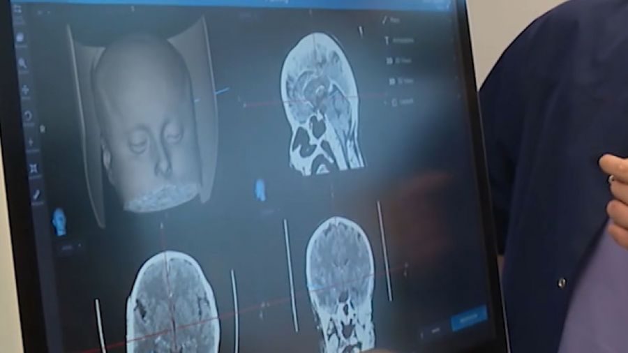 Nowy program lekowy dla pacjentów z ciężką postacią migreny